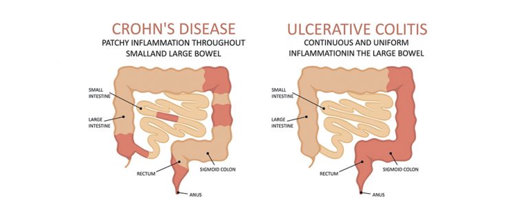Crohn's and Colitis: What Exactly is the Distinction?