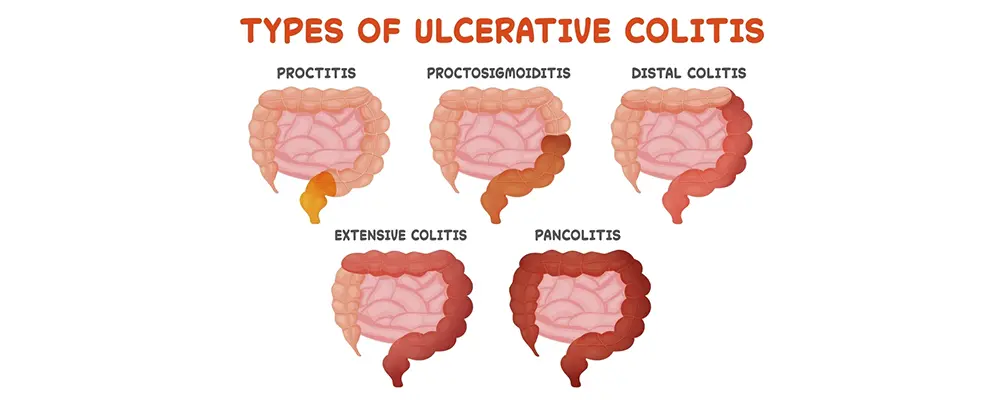 Types Of Ulcerative Colitis Ulcerative Colitis Ayurvedic Treatment