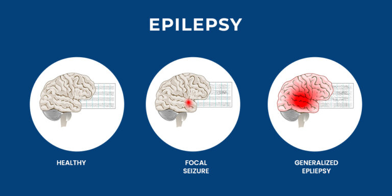 Idiopathic Epilepsy: Overview, Causes and Treatments Options